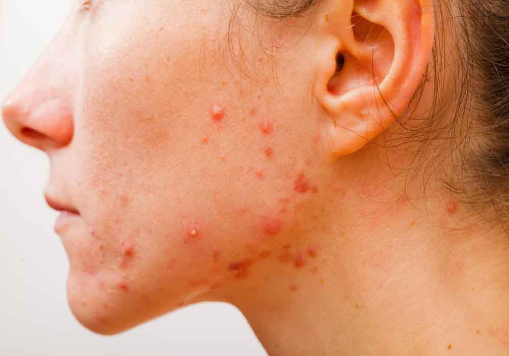 Cystic Acne Easy Steps To Get Rid Of It Cystic Acne Easy Steps To Get Rid Of It