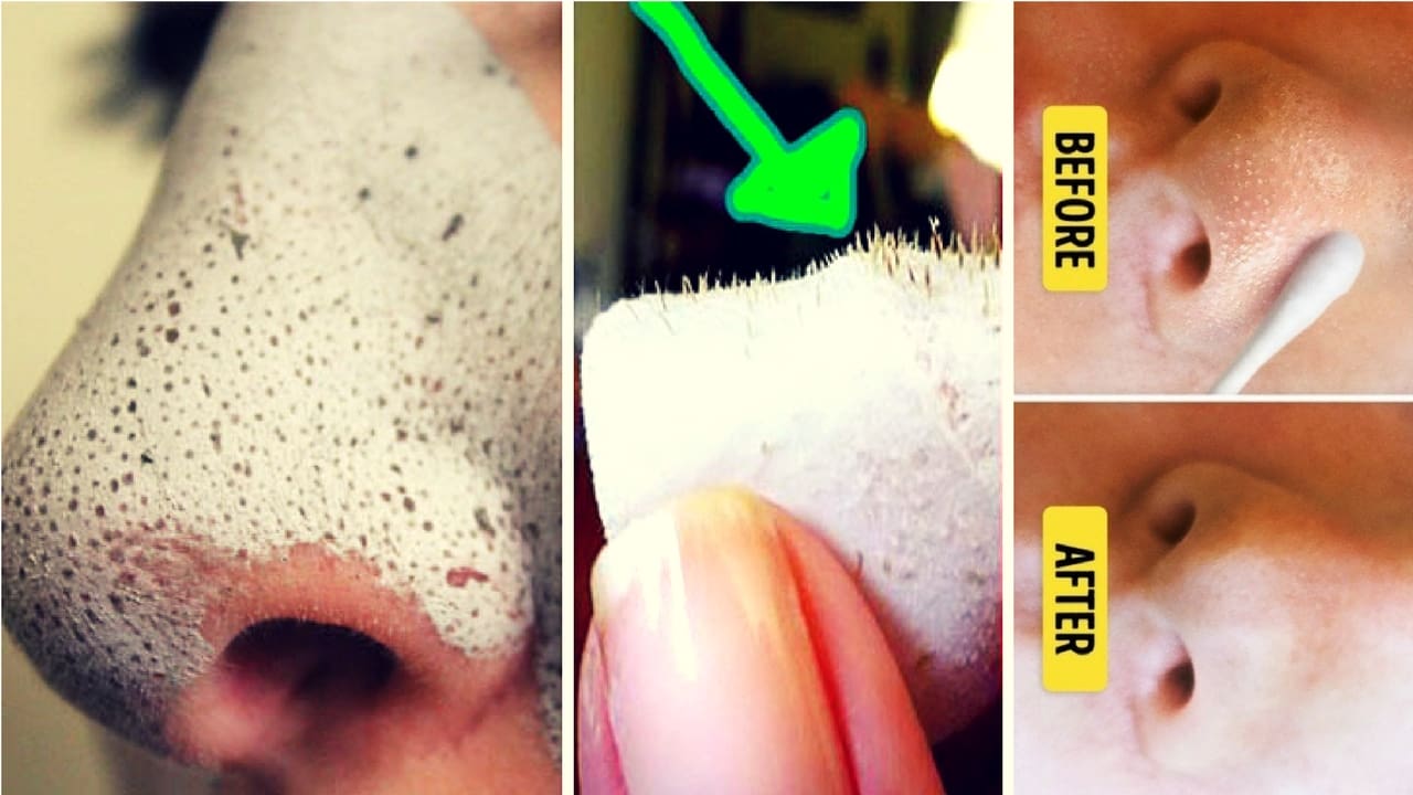 How To Get Rid Of Whiteheads